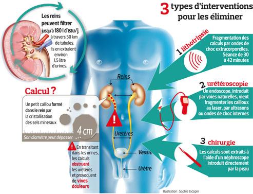 Des procédures simplifiées contre les calculs rénaux