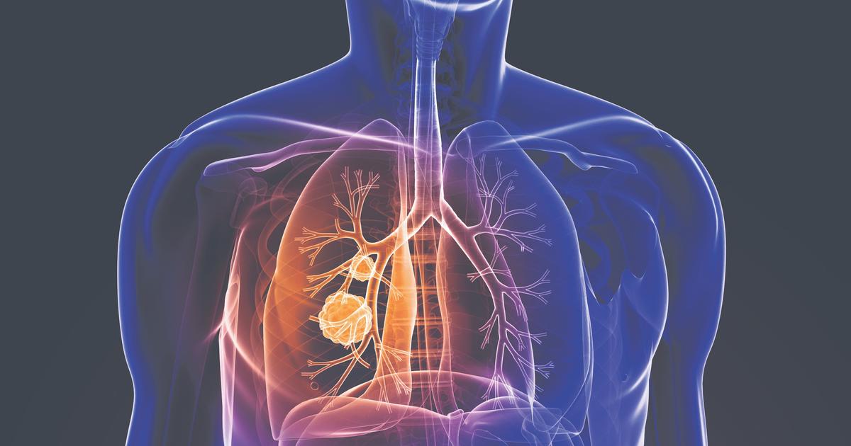 Une thérapie ciblée prolonge la vie dans certains cancers du poumon