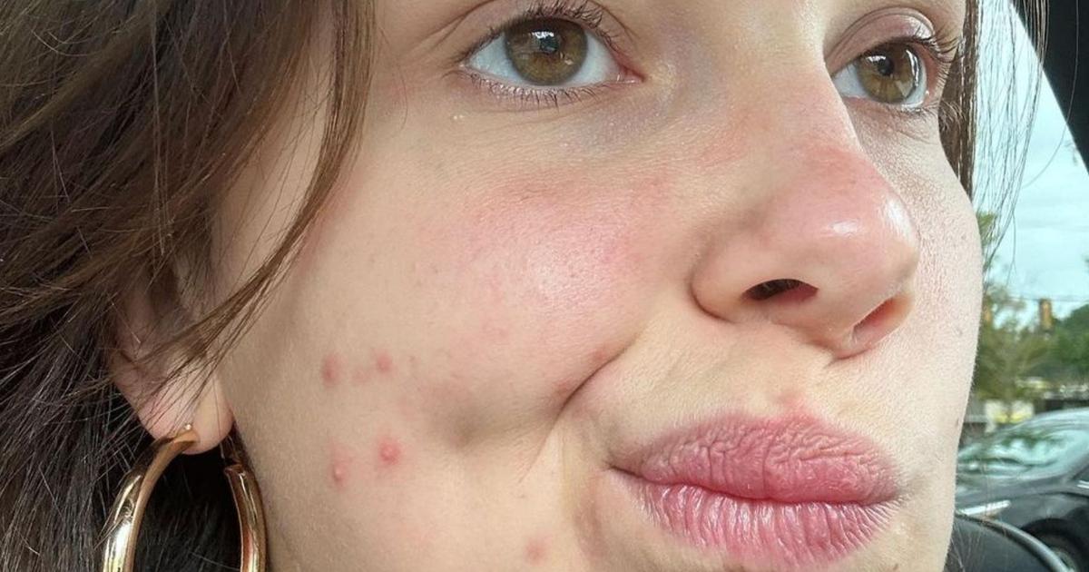 Boutons d’acné sur les joues et le front : la photo avant/après de ...