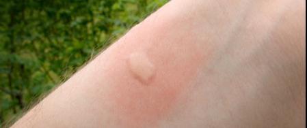 Éruption cutanée : causes, symptômes et traitement