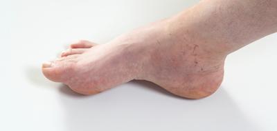 Ulcère variqueux : causes, symptômes et traitements