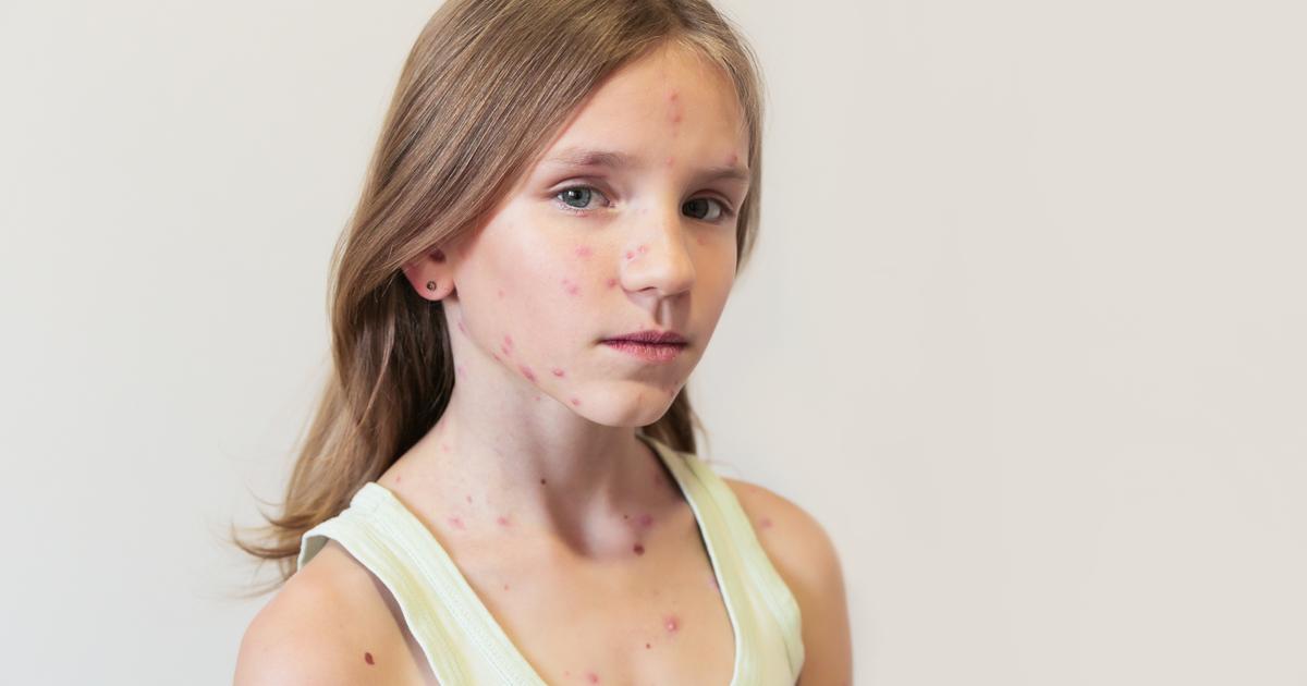Varicelle : les symptômes fréquents et l'évolution