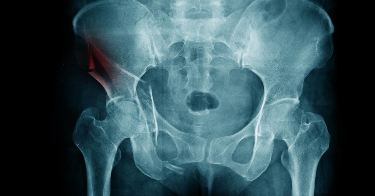 Fracture du bassin : symptômes, causes et traitements