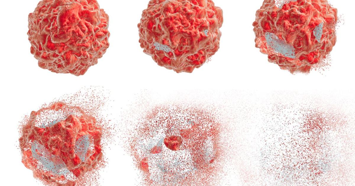 Des résultats spectaculaires dans un cancer rare né dans le placenta