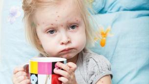 Rubéole : causes, symptômes et vaccination préventive