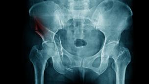 Fracture du bassin : symptômes, causes et traitements
