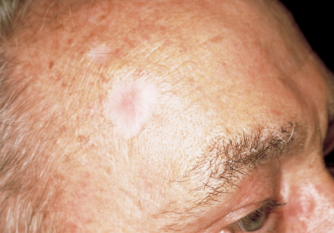 Cancers de la peau : ces signes qui doivent alerter