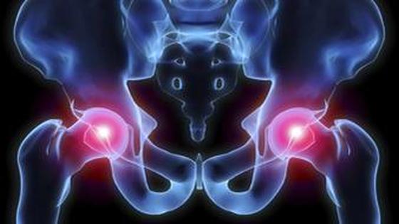 Coxarthrose : symptômes et traitement de la douleur