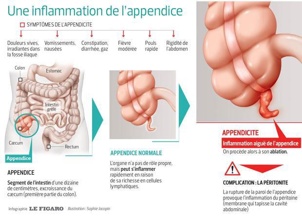 L'appendicite : symptômes, diagnostic et évolution
