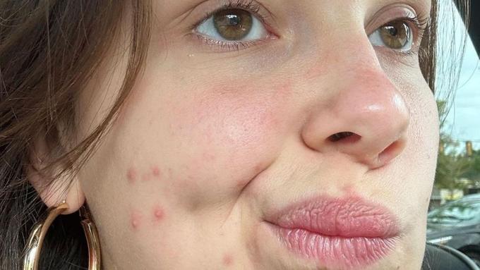 Boutons d’acné sur les joues et le front : la photo avant/après de ...