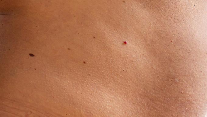 Qu’est-ce que ce petit bouton rouge qui apparaît sur la peau après 30 ans