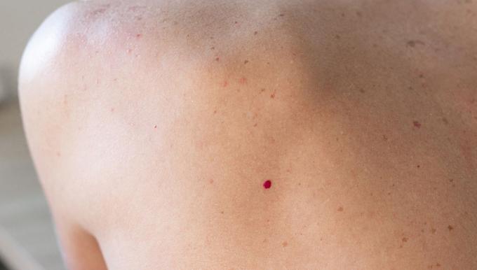Qu’est-ce que ce petit bouton rouge qui apparaît sur la peau après 30 ans