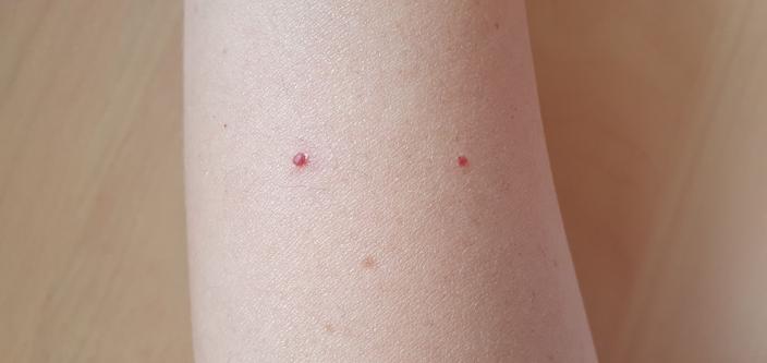 Qu’est-ce que ce petit bouton rouge qui apparaît sur la peau après 30 ans