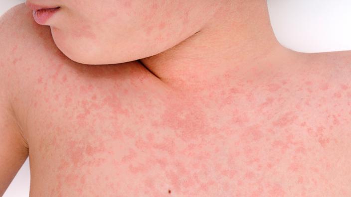 Un début d'épidémie de rougeole «localisée» détecté dans le département ...