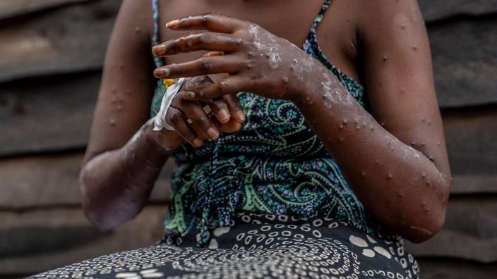 Ghana : un premier décès lié au virus mpox