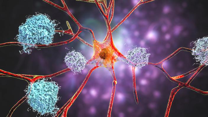 Alzheimer : des cellules cérébrales modifiées génétiquement pour s ...