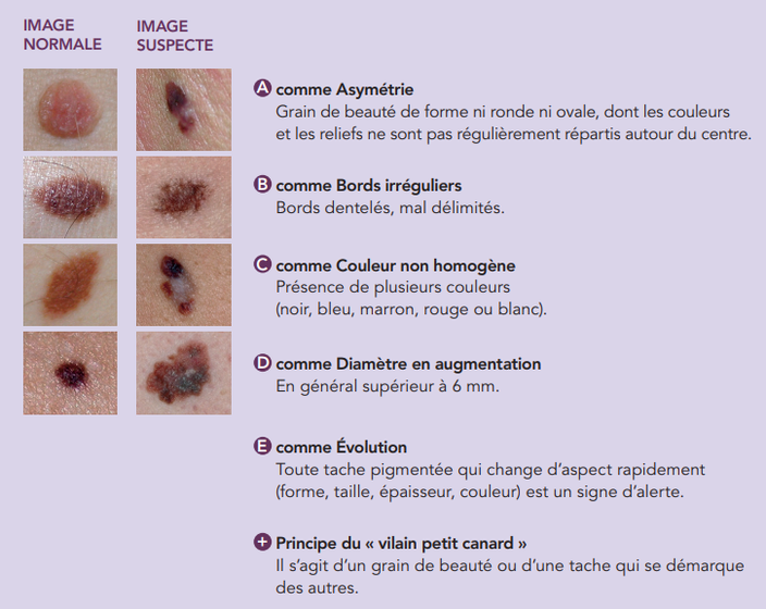 Cancers de la peau : ces signes qui doivent alerter