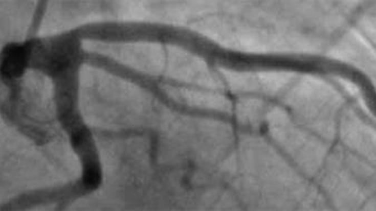 Coronarographie/ coroscanner : informations et actualités