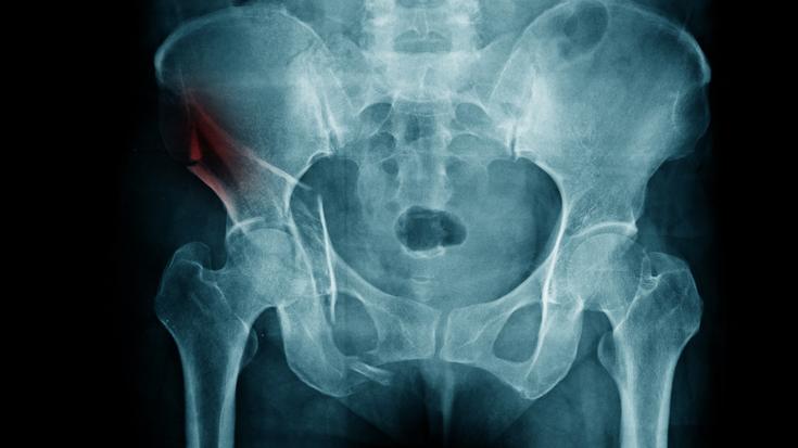Fracture du bassin : informations et actualités