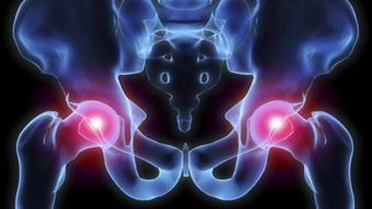 Coxarthrose : symptômes et traitement de la douleur
