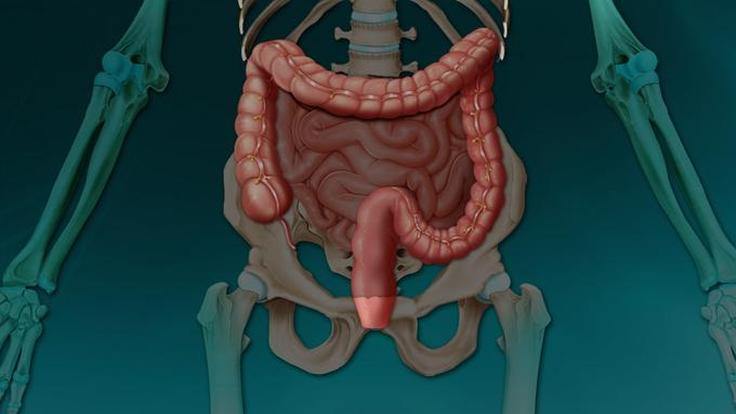 Réctocolite hémorragique : symptômes et traitements