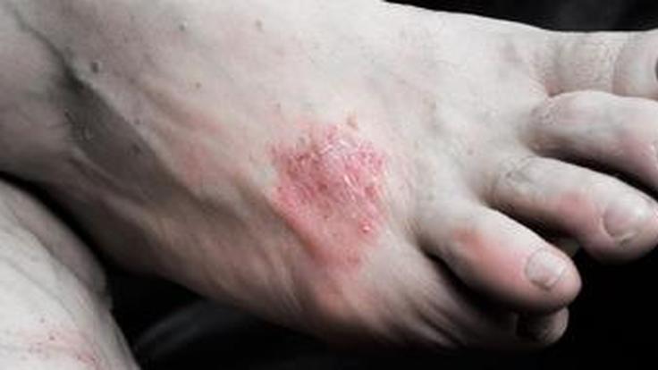 Psoriasis : taches de bougies, symptômes à connaître