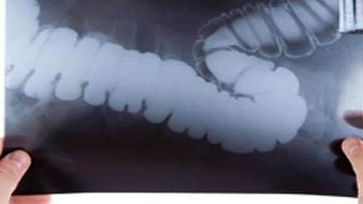 Polypes colo-rectaux : symptômes, causes et traitements