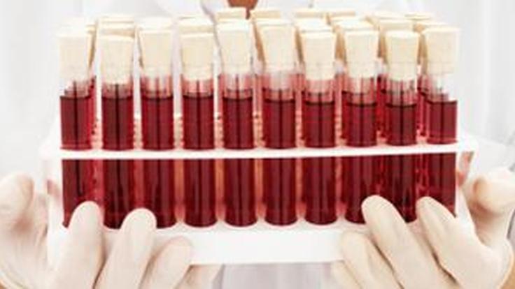 Ionogramme : comment se déroule cet examen médical