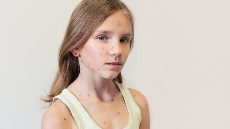 Varicelle : les symptômes fréquents et l'évolution