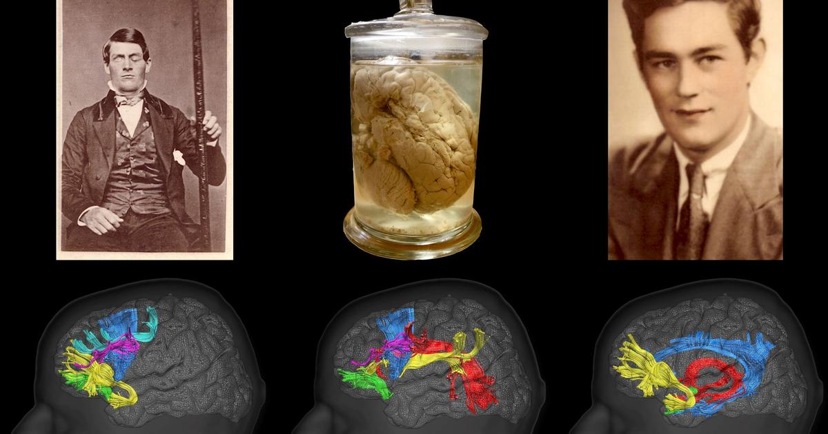 Ces trois accidents qui ont révolutionné les neurosciences
