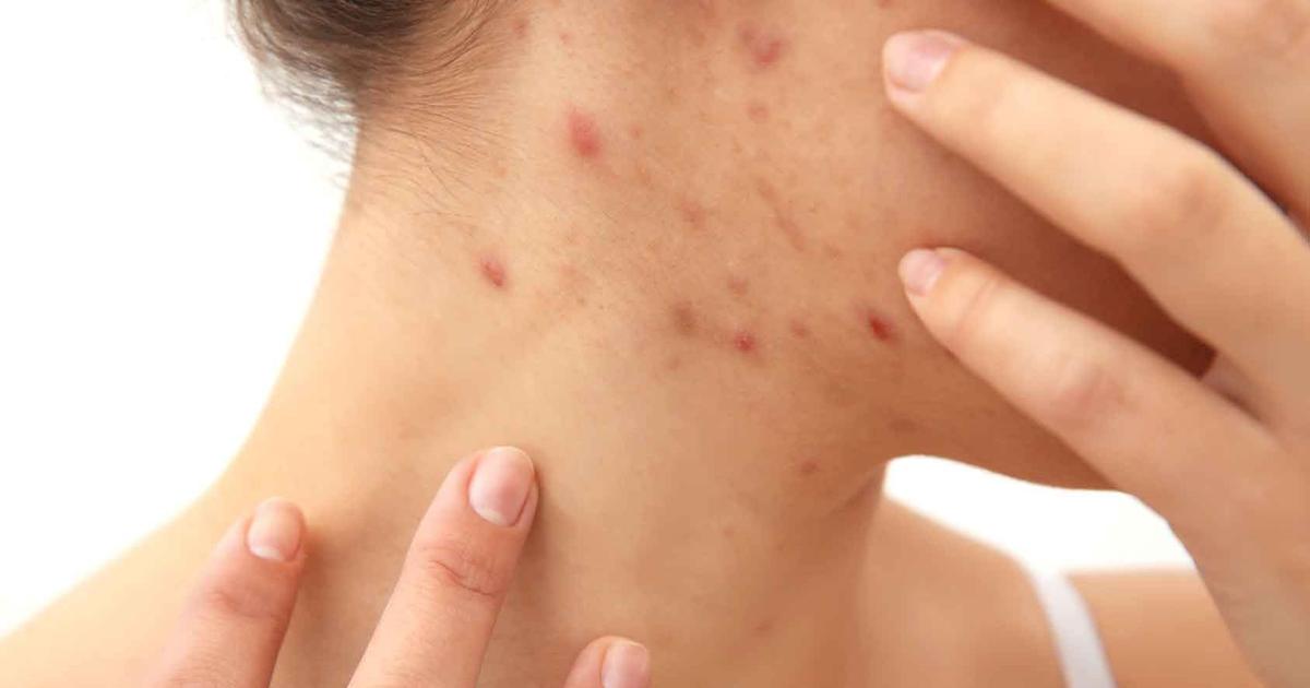 Acné : des recommandations très précises