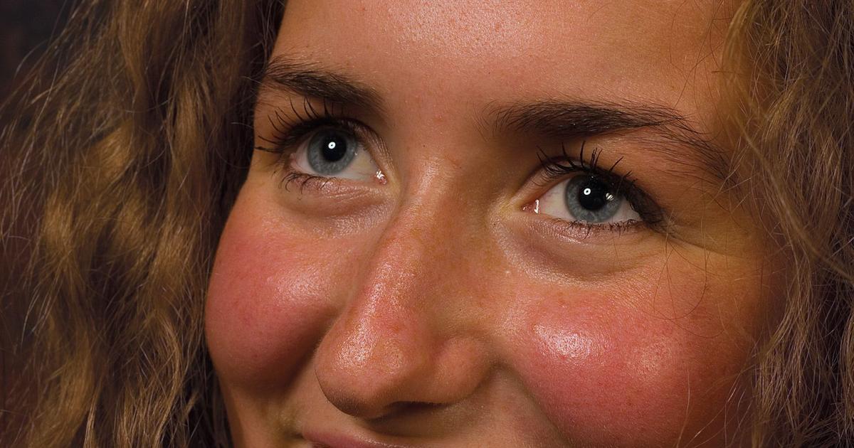 Lutter contre la rosacée