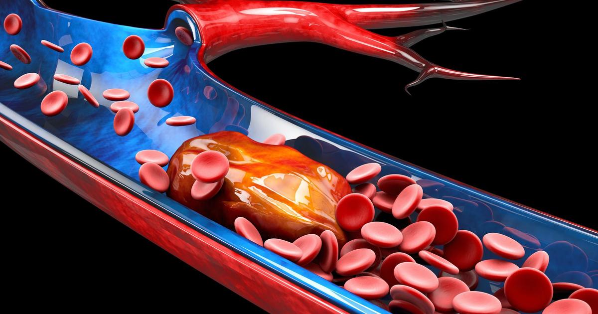 Une piste pour expliquer les thromboses rares liées au vaccin d’AstraZeneca
