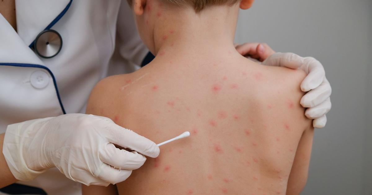 Varicelle et zona, un seul virus pour deux maladies différentes