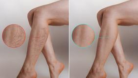 Bien choisir son laxatif