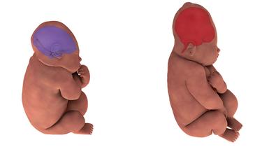 Comment la tête d’un bébé se déforme pendant l’accouchement