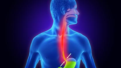 Remontées acides: comment les soulager?