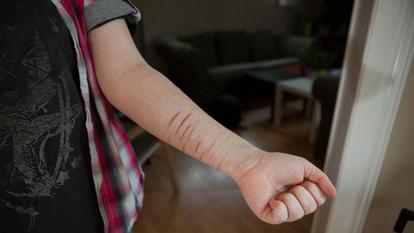 Automutilation chez l’adolescent, comment réagir?