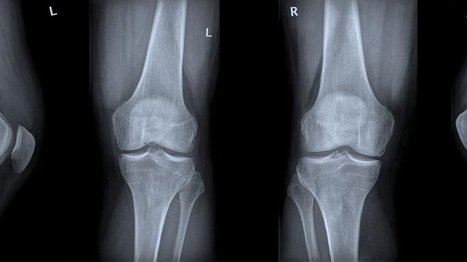 L’arthrose du genou est deux fois plus fréquente qu’il y a 100 ans