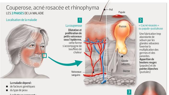Couperose, rosacée: d’où viennent ces rougeurs au visage?