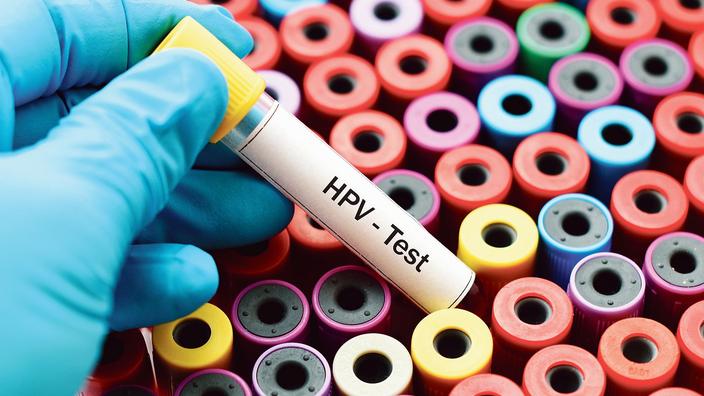 Avec le test HPV, de nouvelles stratégies et de futurs défis pour le ...
