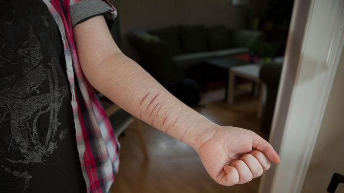 Automutilation chez l’adolescent, comment réagir?