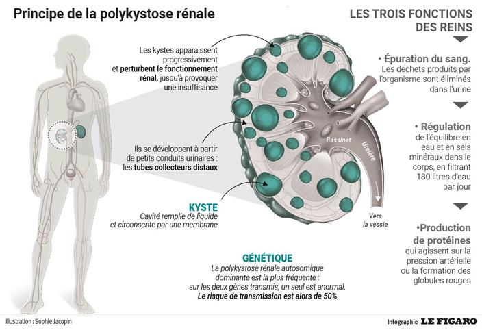 Polykystose rénale: quand des kystes détruisent les reins