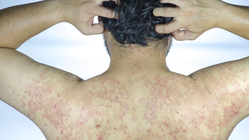 Psoriasis : certains traitements peuvent presque faire oublier la maladie