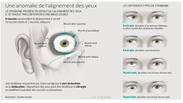 Même à l’âge adulte, le strabisme peut (ré)apparaître