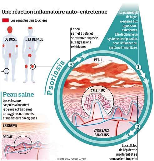 Psoriasis : l'inflammation dans la peau