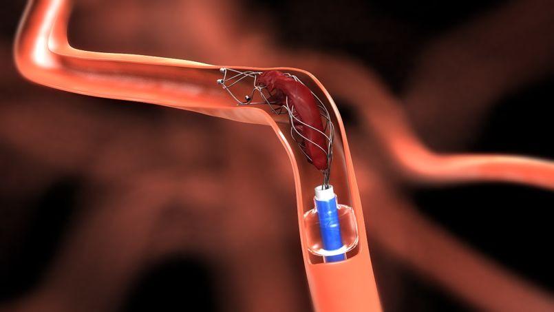 Une nouvelle méthode de traitement des AVC fait ses preuves