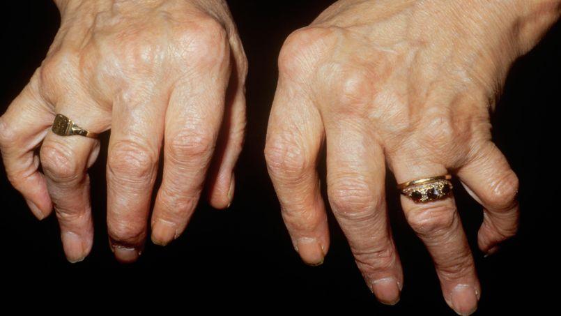 Polyarthrite rhumatoïde: traiter vite est essentiel