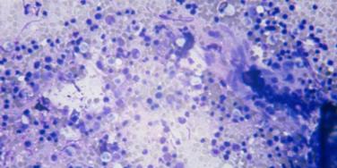 Myélogramme - Quels sont les résultats du myélogramme ? - Fiches santé ...