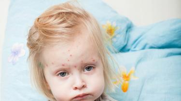 Rubéole - La rubéole congénitale - Fiches santé et conseils médicaux